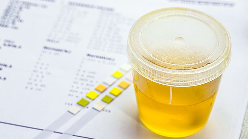 Urine-based Test Shows Promise in Detecting Bladder Cancer – # ...